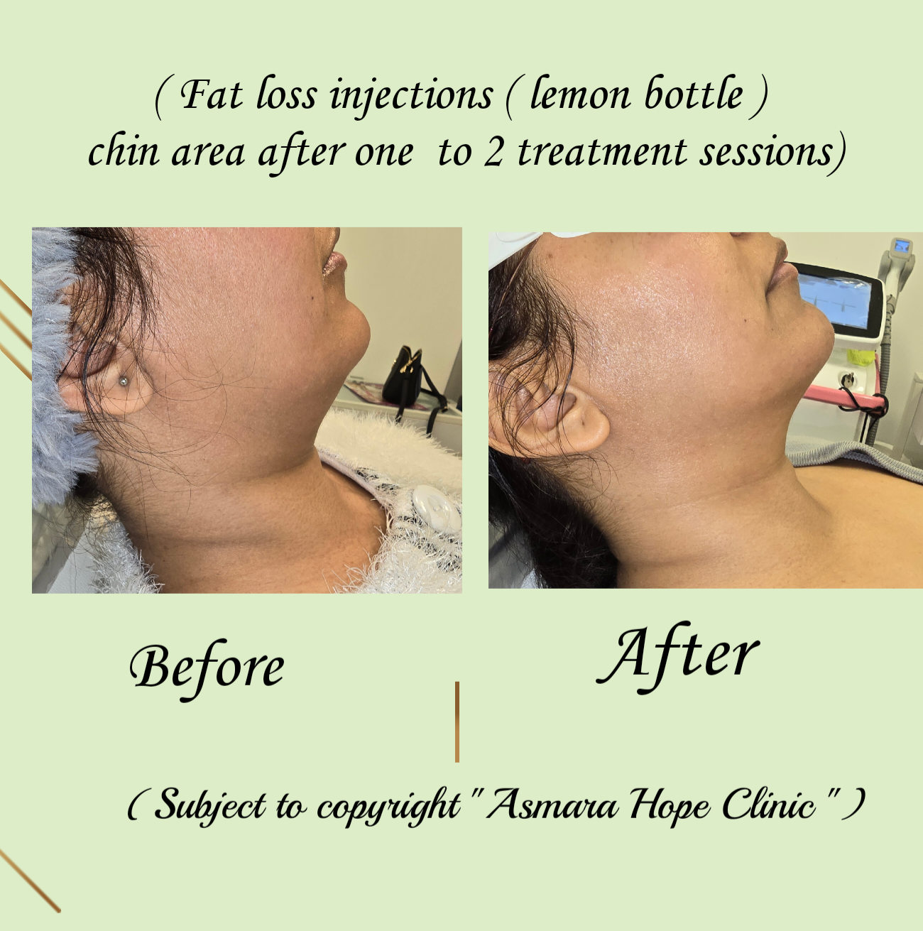 Fat loss injections
